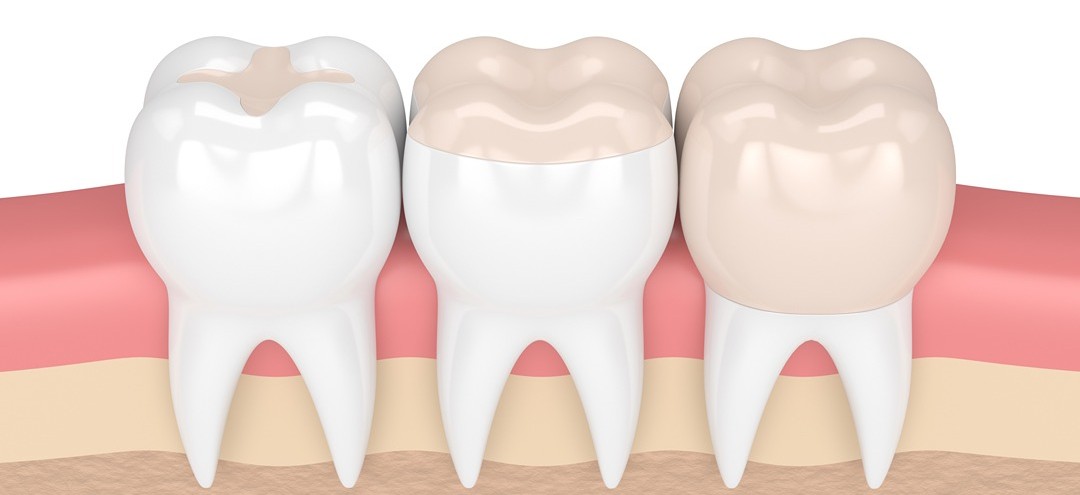 Inlays and Onlays - healthysmiles